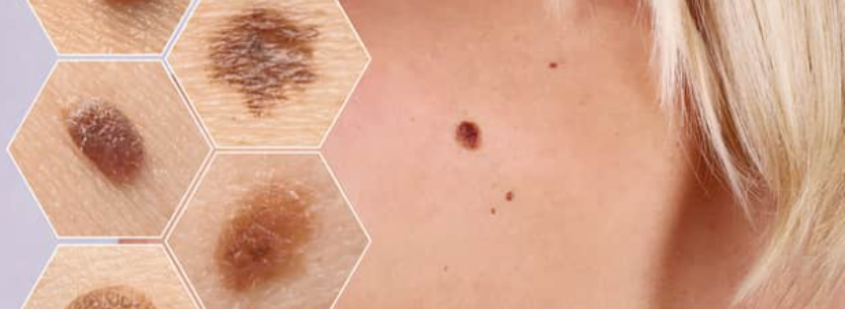 Can A Desk Lamp Cause Skin Cancer | Detroit Chinatown